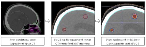 Single Isocenter Linac Based Radiosurgery For Brain Metastases With Coplanar Arcs A Dosimetric
