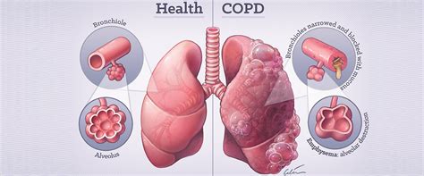 Top Copd Treatment Options In July Complete Guide For Chronic