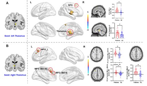 Brain Regions With Fc Alterations In Patients With Migraine A Relative Download Scientific
