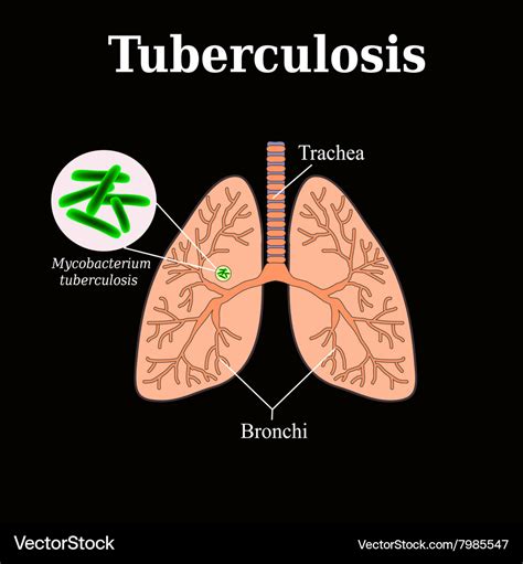 Tubercle Tuberculosis