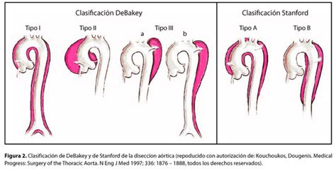 Diseccion Aórtica Estado Actual