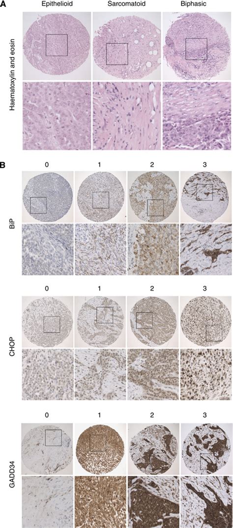 Tissue Microarray Stained For Markers Of Er Stress A Tissue Download Scientific Diagram