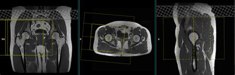 Mri Arthrogram Hip Protocol And Planning Indications For Mri Arthrogram Hip Scan