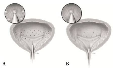 Posts Void Residual Measurement Cystometric Test Download Scientific Diagram