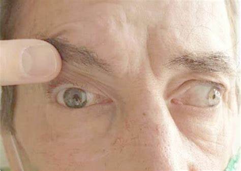 Re Adduction Deficit Figure 5 Re Supraduction Figure 6 Re