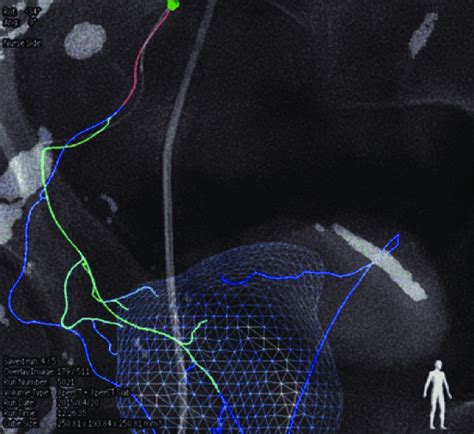 3 Cone Beam Ct Angiogram Using Emboguide Phillips Guidance Software Download Scientific
