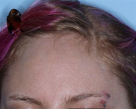Before And After Photos Zoryve® Foam For Plaque Psoriasis