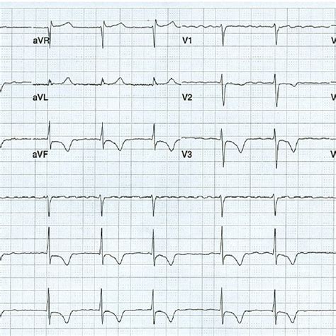 PDF T Wave Inversion Cardiac Memory Or Myocardial Ischemia