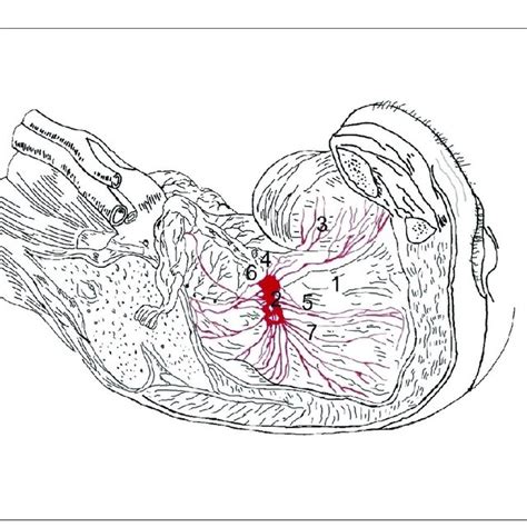 Division Of Cases According To Lateral Asymmetry Of The Pelvic Plexus