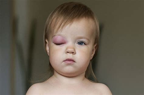 Orbital Cellulitis Symptoms Causes And Treatment