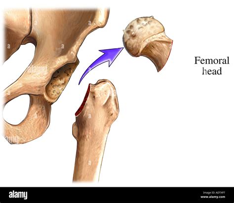 Femoral Head And Neck