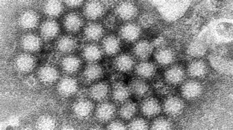 Norovirus Outbreaks Surge Experts Stress Hygiene And Disinfection