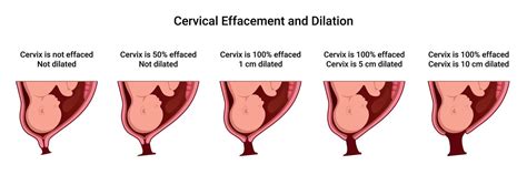 Cervical Effacement Dilation Cervical Effacement Cervix Dilation