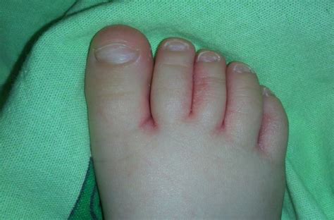 Шелушится кожа между пальцами ног причины и лечение