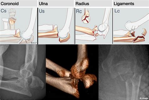 Prognostic Value Of The Curl Classification System For Proximal Ulna