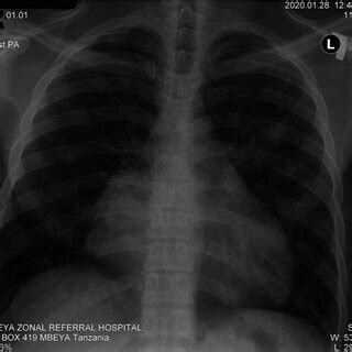 Chest Radiography PA Bilateral Diffuse Pulmonary Nodular Lesions And Download Scientific