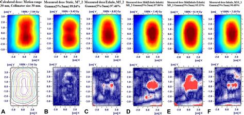 Dosimetric Effect Of Intrafraction Tumor Motion In Lung Stereotactic Body Radiotherapy Using