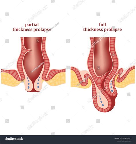 Anal Prolapse Hemorrhoids Diagram Scheme Disease Stock Vector Royalty