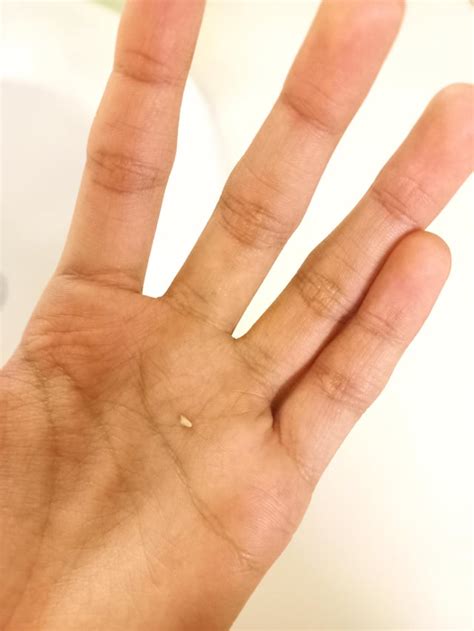 This Tiny Piece Of My Teeth Came Out Rteeth