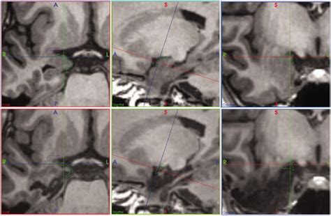 Full Article Resection Of The Piriform Cortex For Temporal Lobe Epilepsy A Novel Approach On