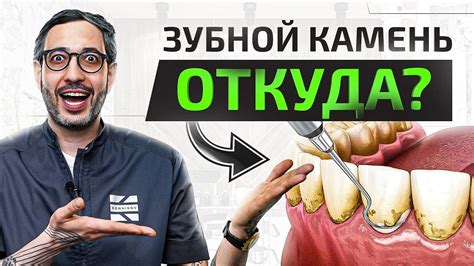 Удаление зубного камня. Домашние средства от зубного налета - YouTube