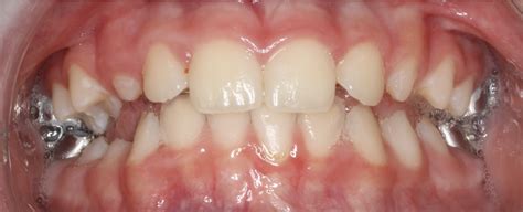 Root Exposure Of A Lower Permanent Incisor