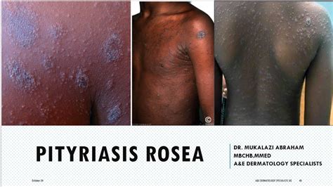 Pityriasis Rosea African American Face Psoriasis On Black Skin
