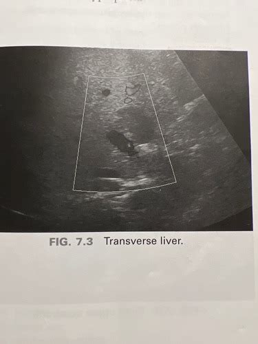 Ch 7 Liver Questions Flashcards Quizlet