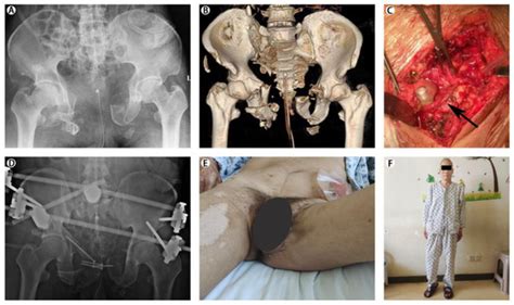 Fracture Types Influence The Likelihood Of Lower Urinary Tract Injuries