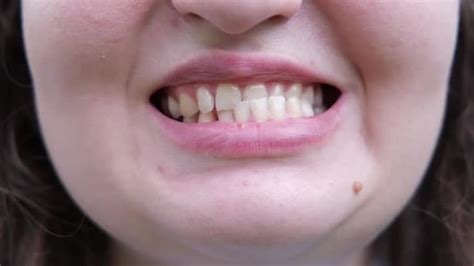 Patient With Dislocated Jaw And Malocclusion Temporomandibular Joint