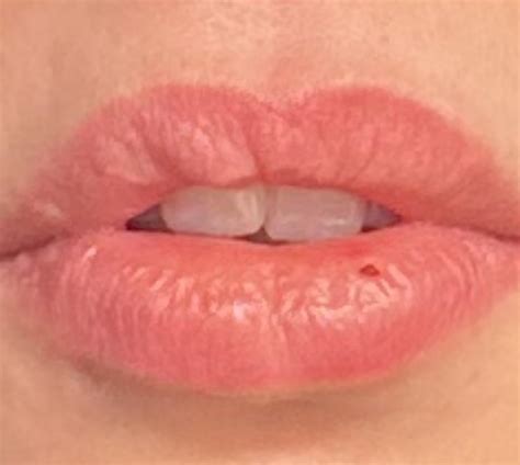 Does Anyone Know Why My Lips Look Like This Warts Please Help Rwarts