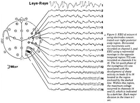 Normal Versus Abnormal Eeg