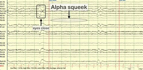 Electroencephalogram Alpha