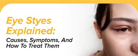 Eye Stye Causes Symptoms And Treatment Guide Wavikar Eye Institute