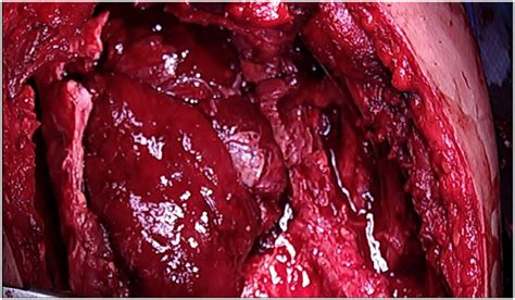 Surgical Resection For Extensive Pleural Epithelioid