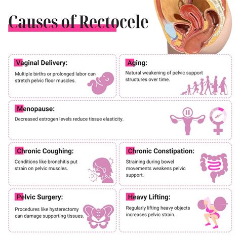 Rectocele Symptoms Female
