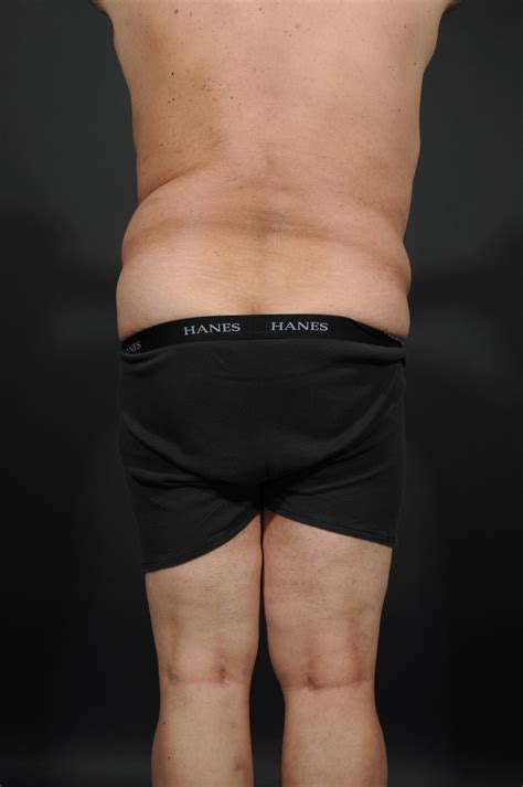 Tummy Tuck With Hernia Repair Before And Afters 06 Dr Trovato