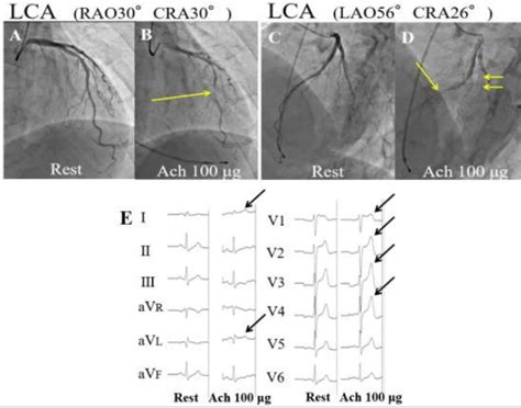 Vasospastic Angina After Pfizer Mrna Covid 19 Shots Jesse Santiano Md
