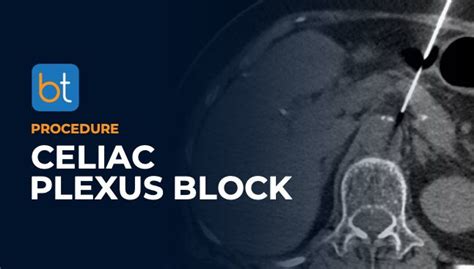 Celiac Plexus Block Procedure Backtable Vi