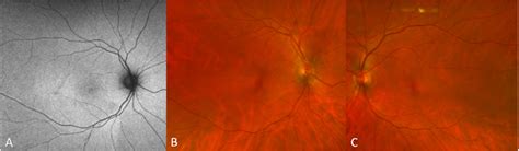 Immediately Following The Lpi Same Day Fundus Autofluorescence Of The