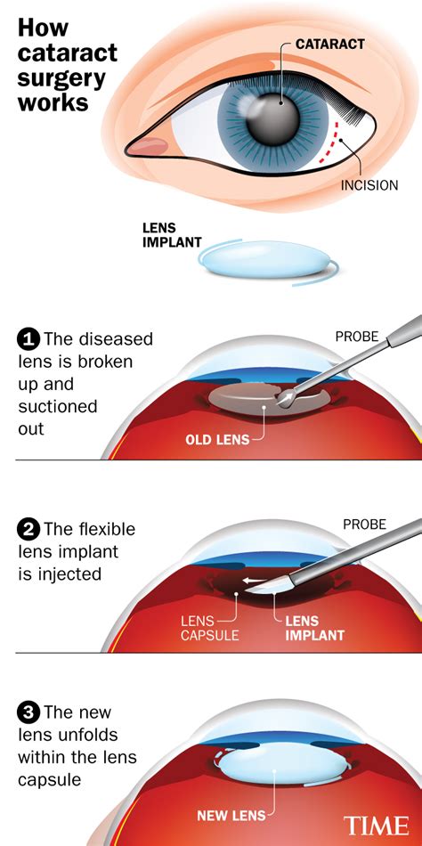 Cataract Surgery What Is It How Does It Work Robotic Cataract Surgery