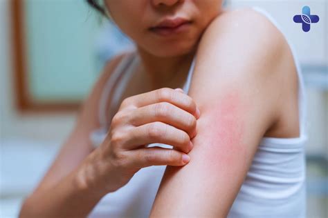 Skin Rash With Fever In Bali 2025 Guide Life Everyouth