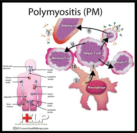 Polymyositis Polimiositis