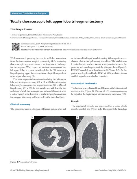 Pdf Totally Thoracoscopic Left Upper Lobe Tri Segmentectomy