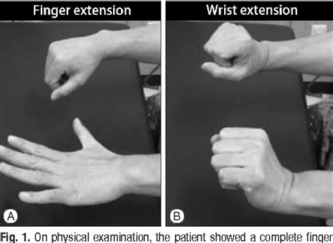 Figure 1 From Neuralgic Amyotrophy Manifesting As Mimicking Posterior Interosseous Nerve Palsy