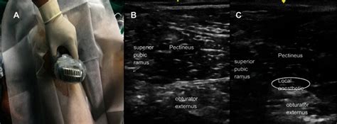 Ultrasound Guided Proximal Obturator Nerve Block A Patient Is In Download Scientific Diagram