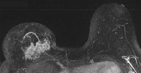 Breast Lift Fat Necrosis At Kristy Breeden Blog