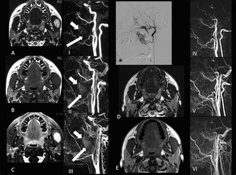 The Role Of Time Resolved Imaging Of Contrast Kinetics Tricks