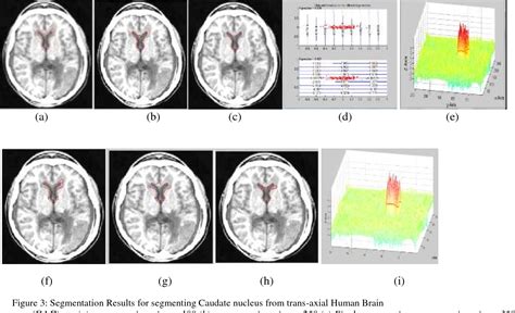 Figure 1 From Performance Evaluation Of Geometric Active Contour Gac And Enhanced Geometric