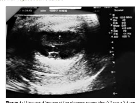 Figure 1 From A Case Of Cavernosal Abscess After Neglected Penile Fracture And Bacteremia
